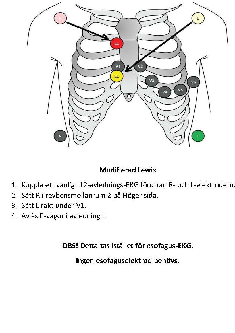 EKG-Lewis-lead-modifierad-bild – Akutentips.info